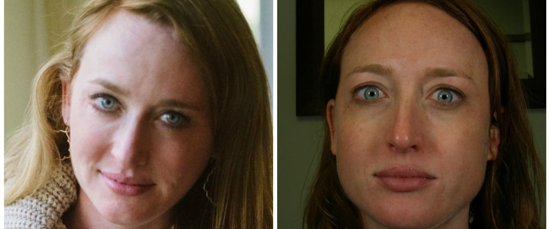 Who Can Benefit from Dysport Injections?